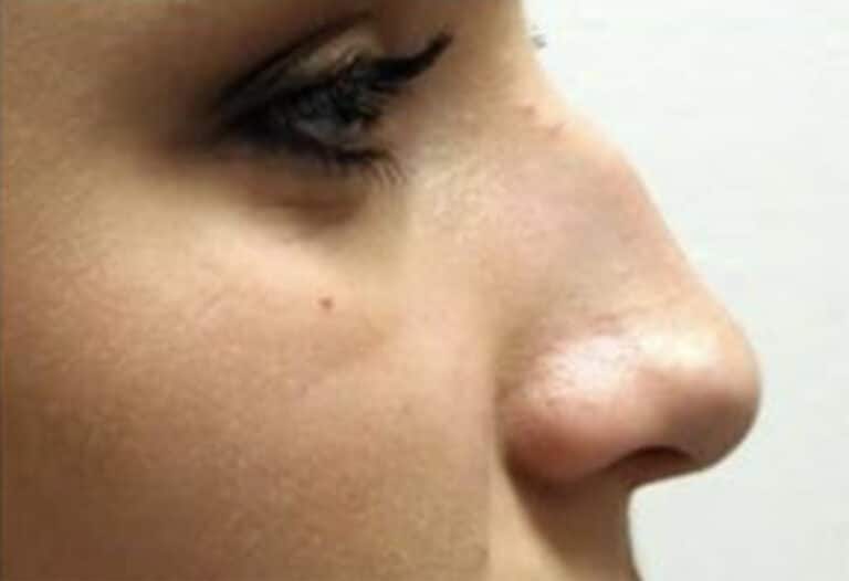 Nasal Reconstruction - Hill Country Ear Nose & Throat